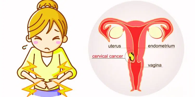 Cervical Cancer's Sneaky Trio: Pelvic Cramps, Bloody Flow, and Odor ...